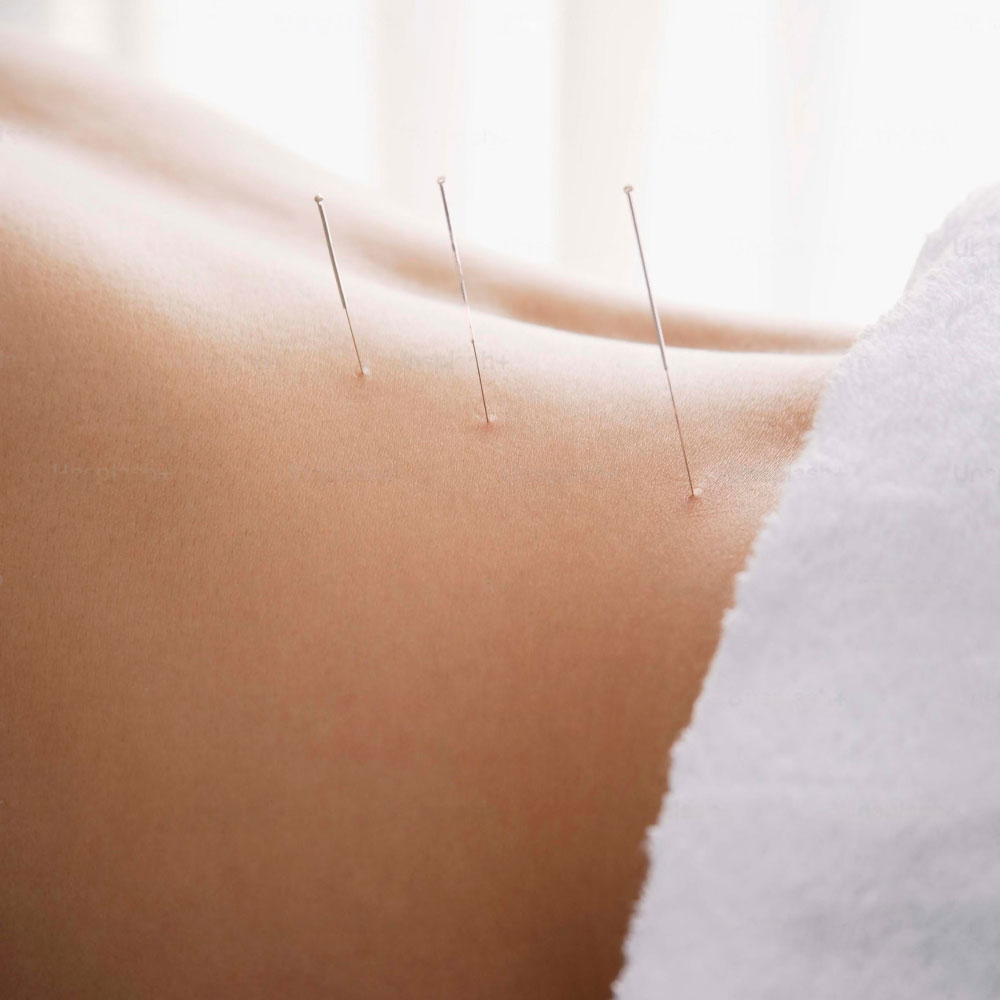 Dry Needling - Masažeus